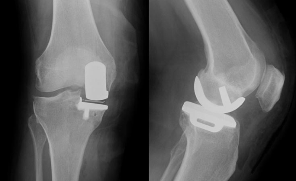 Sussex Knee Surgery | Knee Surgery in Sussex